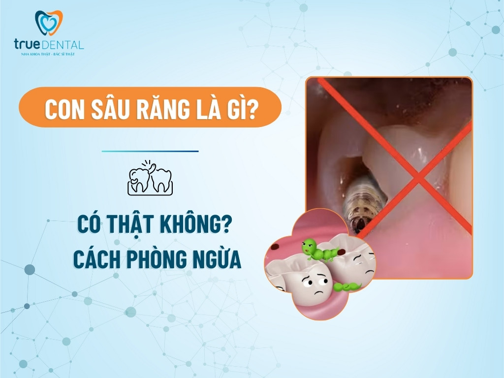 Con sâu răng là gì? Có thật không? Cách phòng ngừa - True Dental - Nha ...