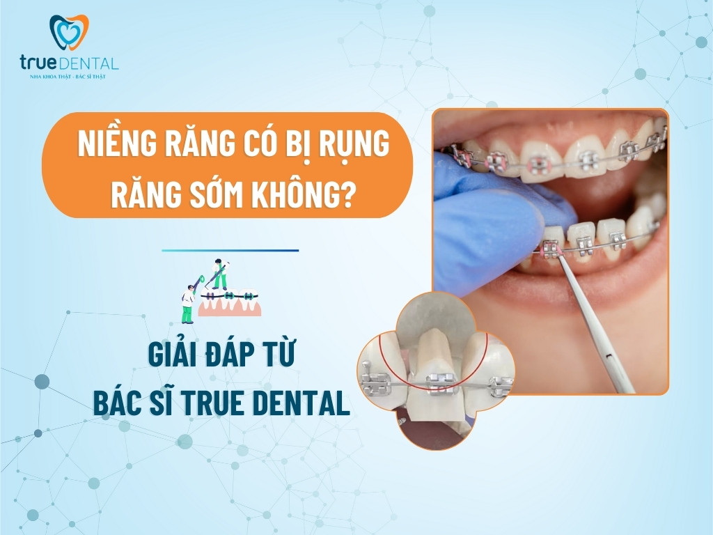 Niềng răng có bị rụng răng sớm không? - True Dental - Nha Khoa Thật ...