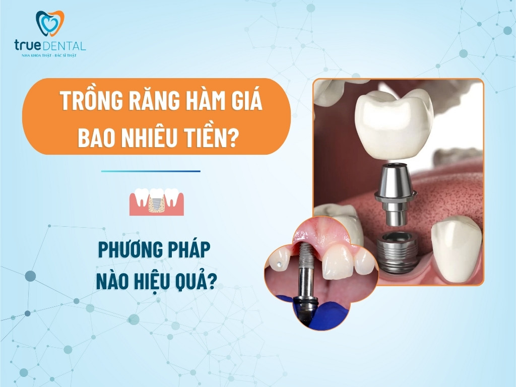 Trồng răng hàm giá bao nhiêu tiền? Phương pháp nào hiệu quả - True ...