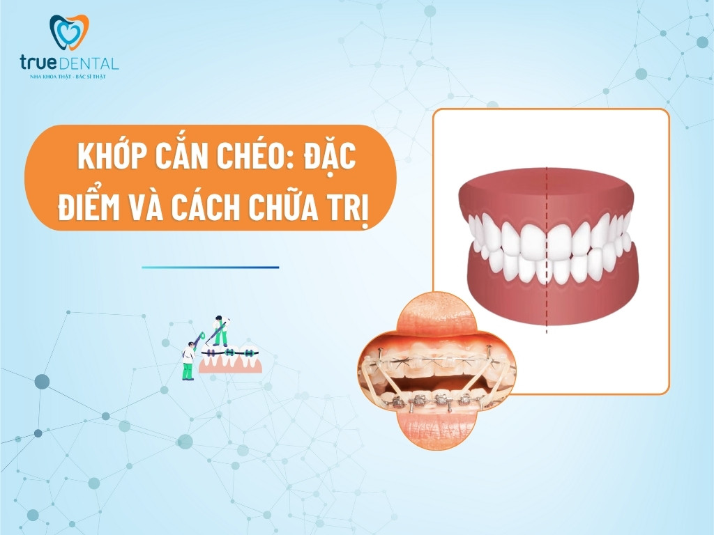 Khớp cắn chéo: Đặc điểm và cách chữa trị - True Dental - Nha Khoa Thật ...