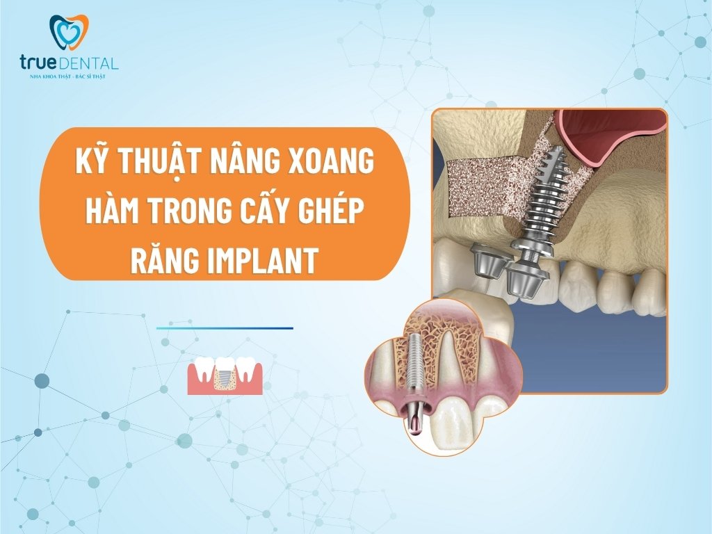 Kỹ thuật nâng xoang hàm trong cấy ghép răng Implant - True Dental - Nha ...
